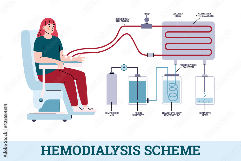 Hemodialysis or kidney dialysis scheme cartoon vector illustration ...