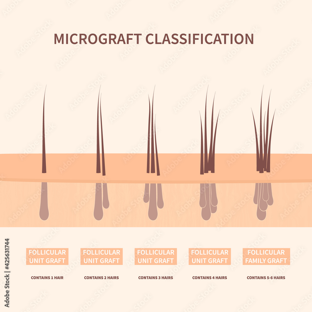 Hair micrograft classification set for hair transplantation surgery ...