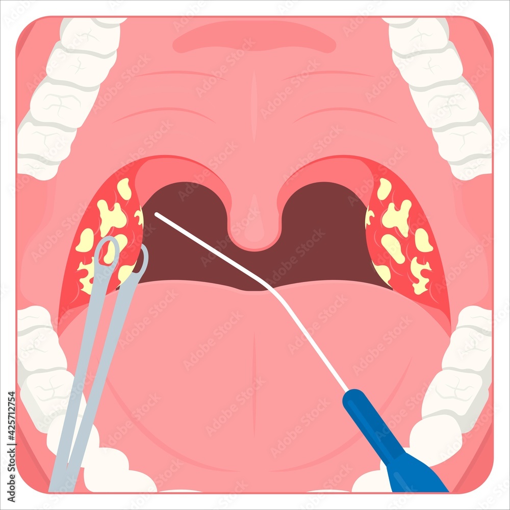 Tonsil Stones crypts viral virus gland strep throat sore enlarged lymph ...