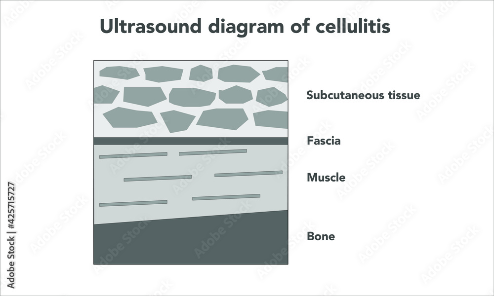 ultrasound diagram of cellulitis shows tissue edema with cobblestone ...