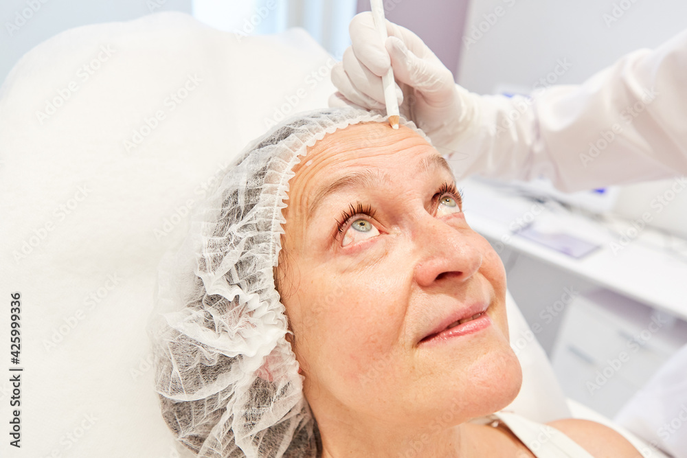Stirnfalten einer Patientin für Facelift markieren Stock Photo | Adobe ...