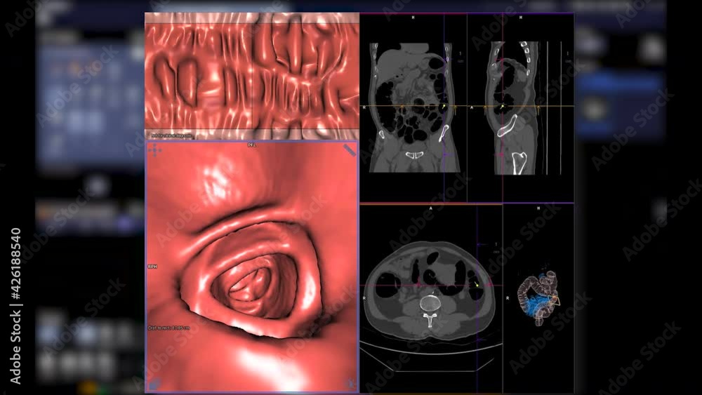 CT colonography compare Axial ,Coronal ,sagittal and 3D rendering movie ...