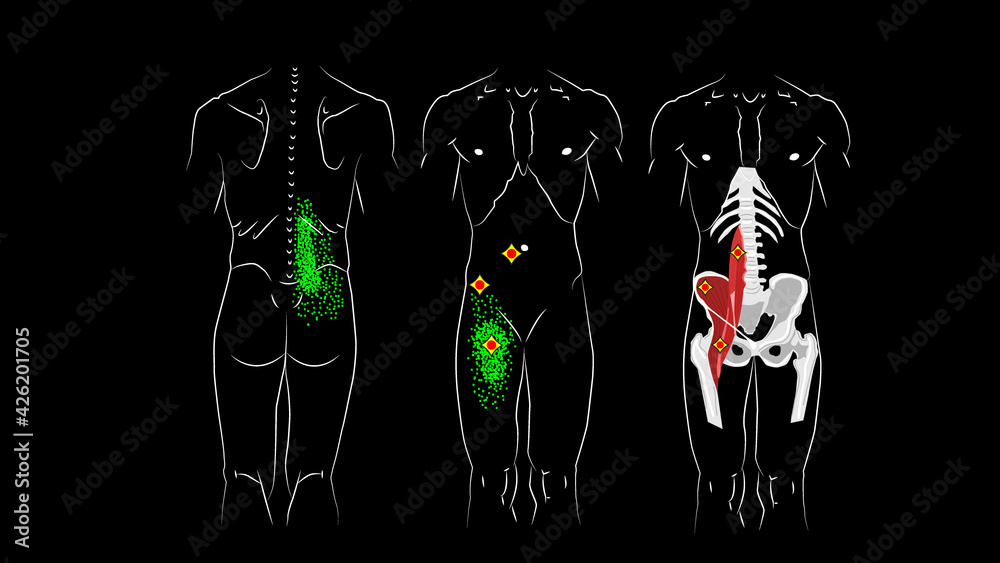 Psoas Muscle Trigger Point