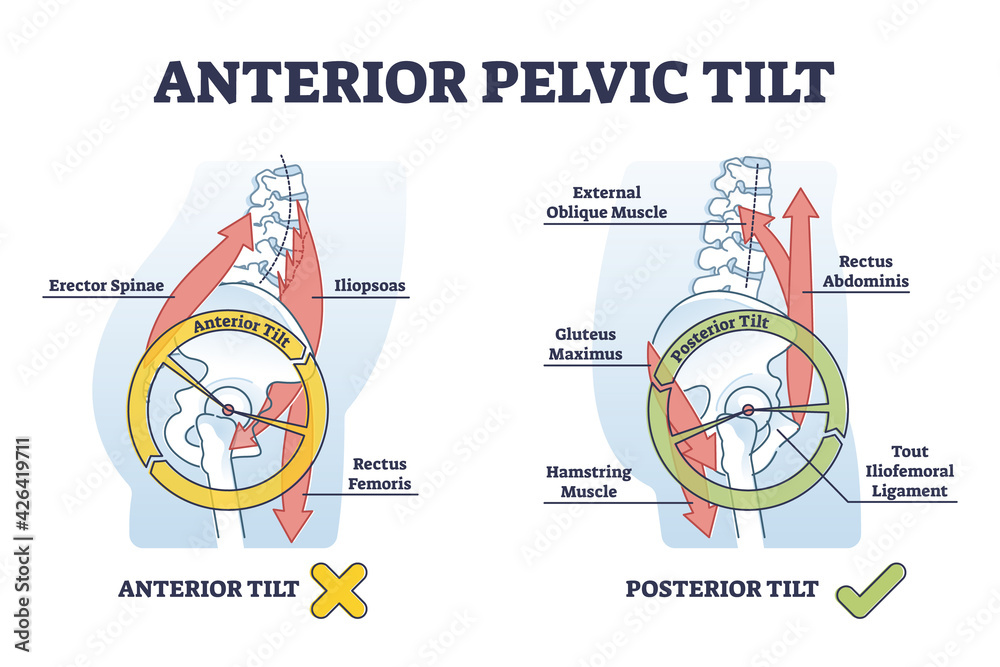 Anterior pelvic tilt model compared with posterior in labeled outline ...