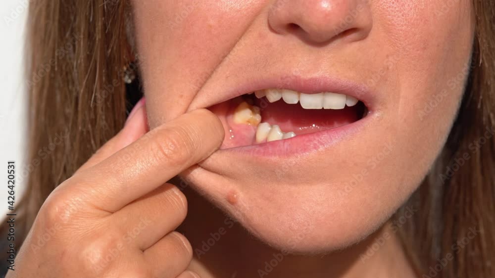 Sad woman showing her mouth without tooth on lower jaw. Missing tooth ...