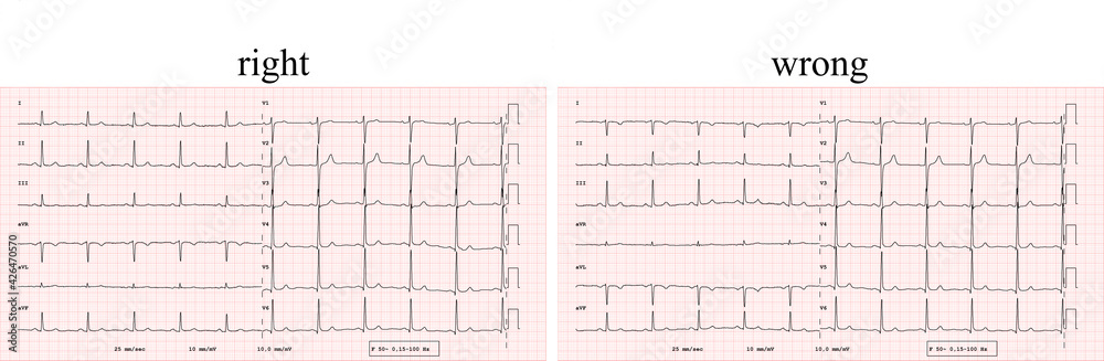 ECG example of a normal 12-lead sinus rhythm, comparison of correct and ...