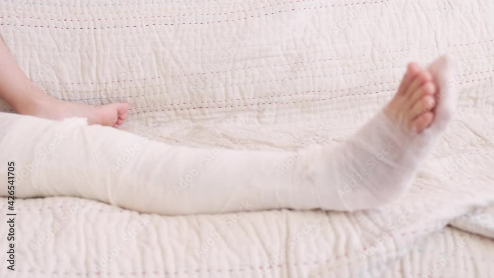 broken leg. Close-up of the cast on the feet. exercises to repair and ...