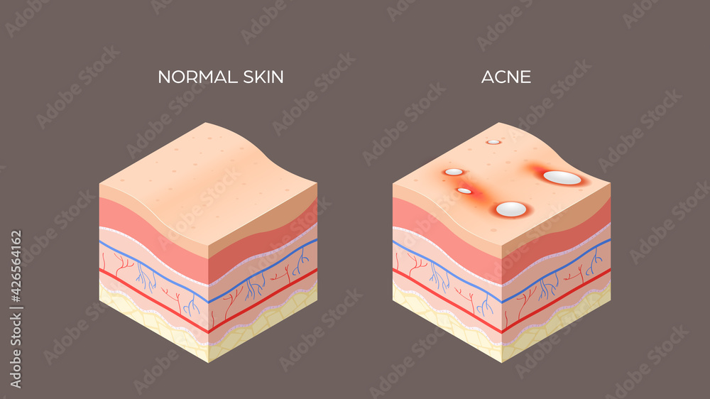 acne vulgaris or pimple and normal skin cross-section of human skin ...