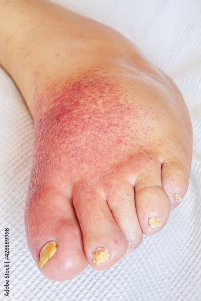 erysipelas of the legs, red rash on the legs.selective focus Stock ...