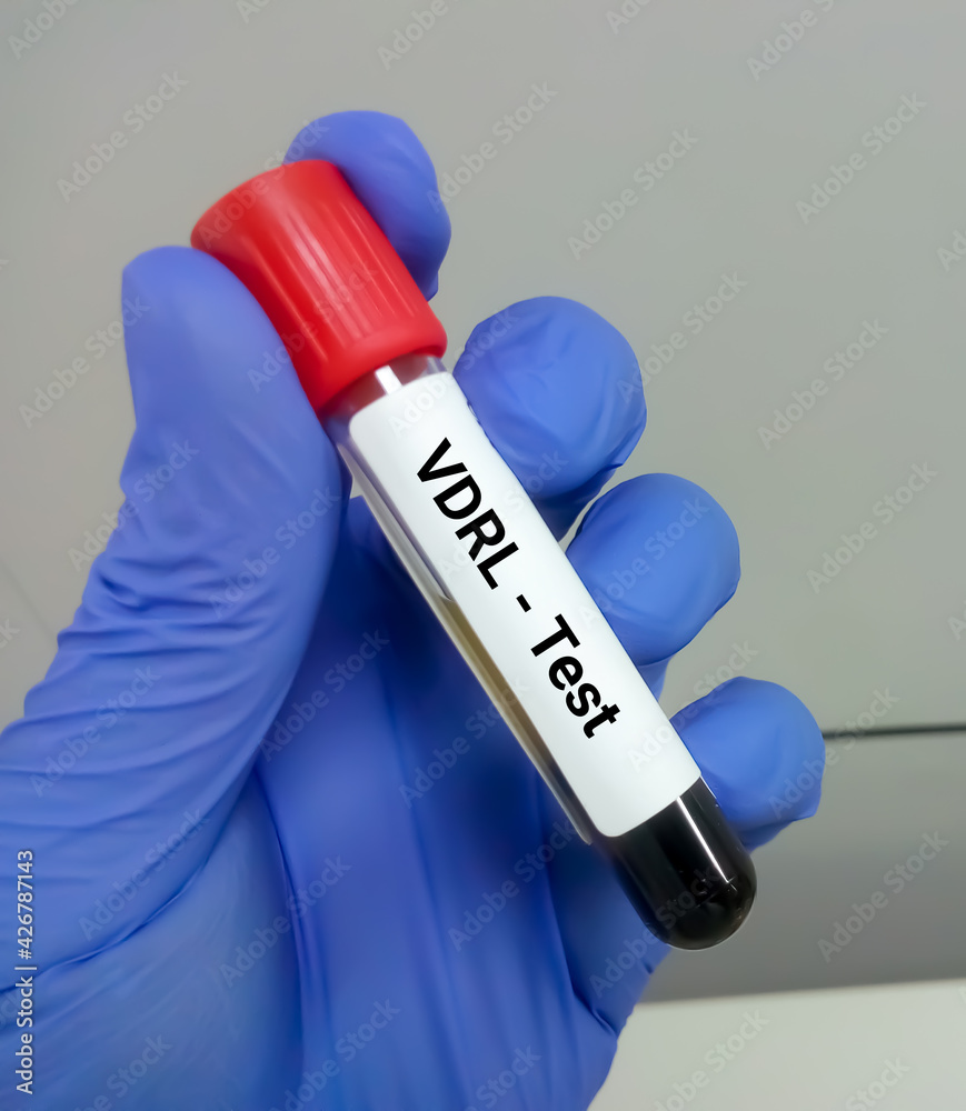 Blood sample tube for VDRL ( venereal disease research laboratory) test ...
