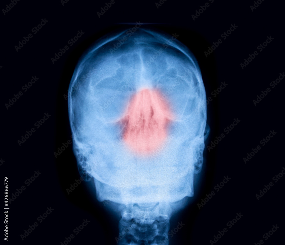 Radiography x-ray film of human skull and paranasal sinuses Stock Photo ...