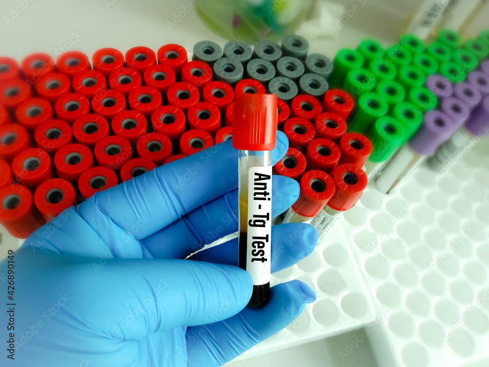 Blood sample tube for anti-Tg or anti-thyroglobulin test, diagnosis for ...