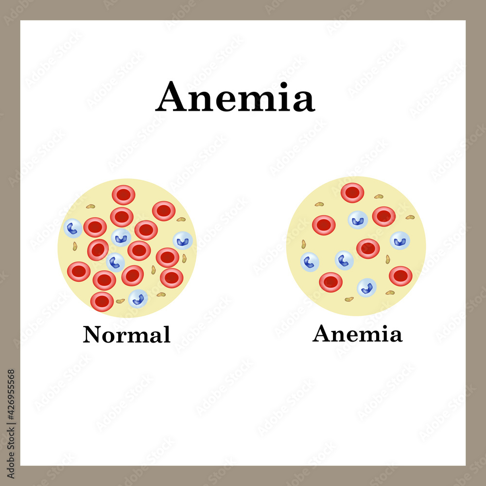 Anemia. The reduced amount of red blood cells. Infographics. Vector ...