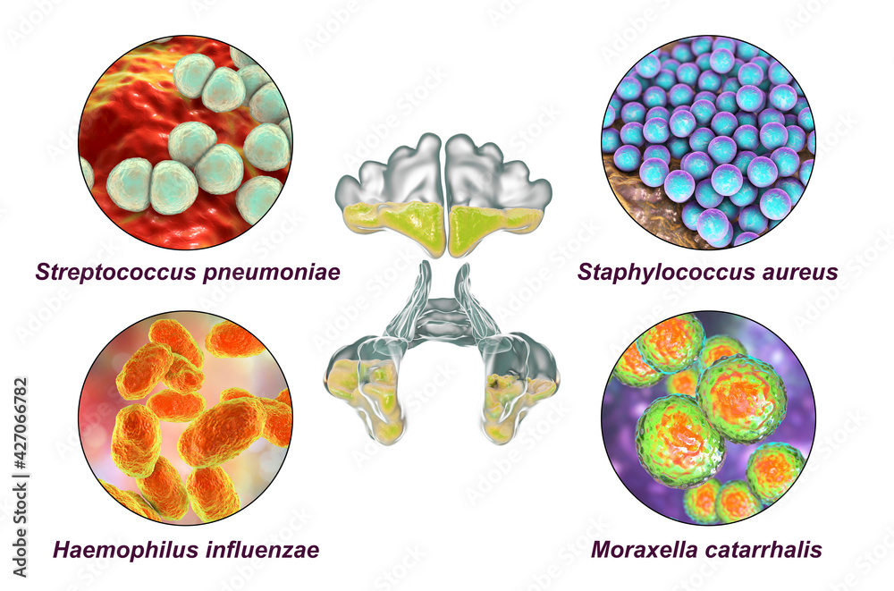 Anatomy of rhinosinusitis and bacteria that cause sinusitis ...