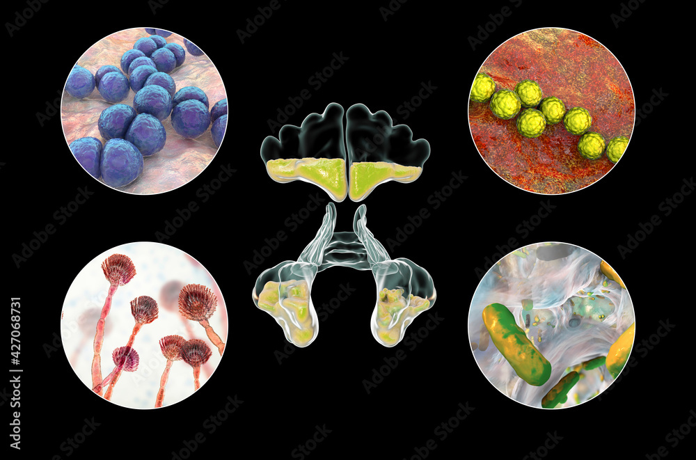 Anatomy of rhinosinusitis and microorganisms that cause sinusitis, 3D ...
