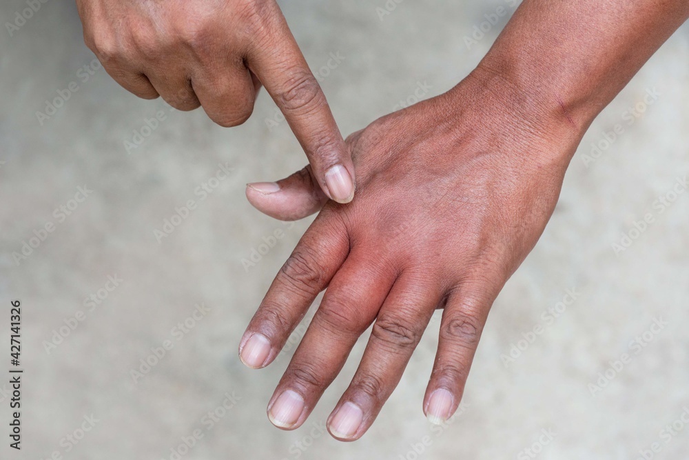 Swollen Hand From Insect Sting Man Pointed To The Finger That Was