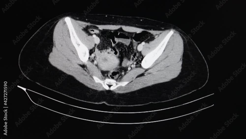 CT Scan of an abdomen of a patient with abdominal pain showing swollen ...