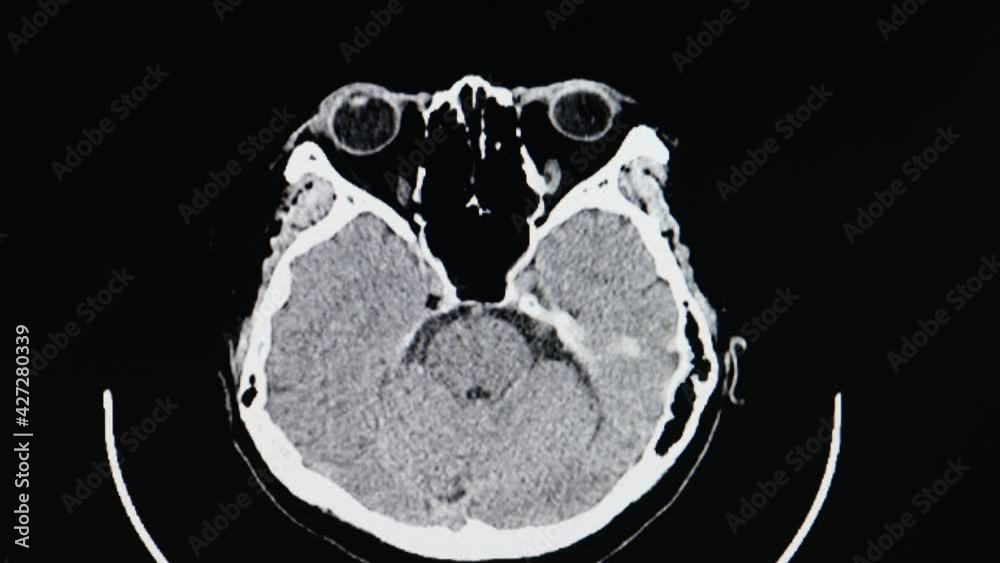 CT cine scan of a patient with weakness of legs showing severe brain ...