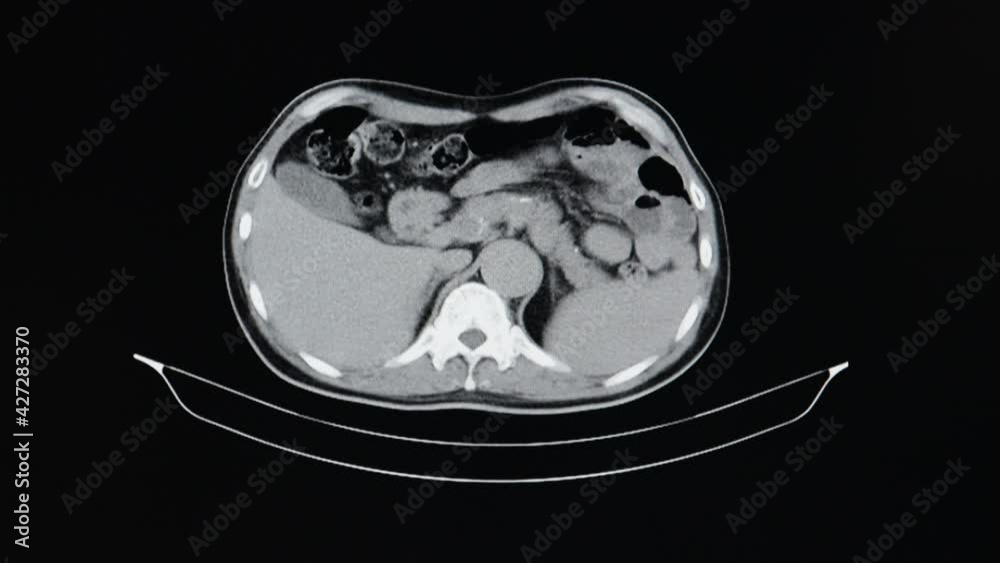 A motion CT scan of an abdomen of a patient with a stent graft ...
