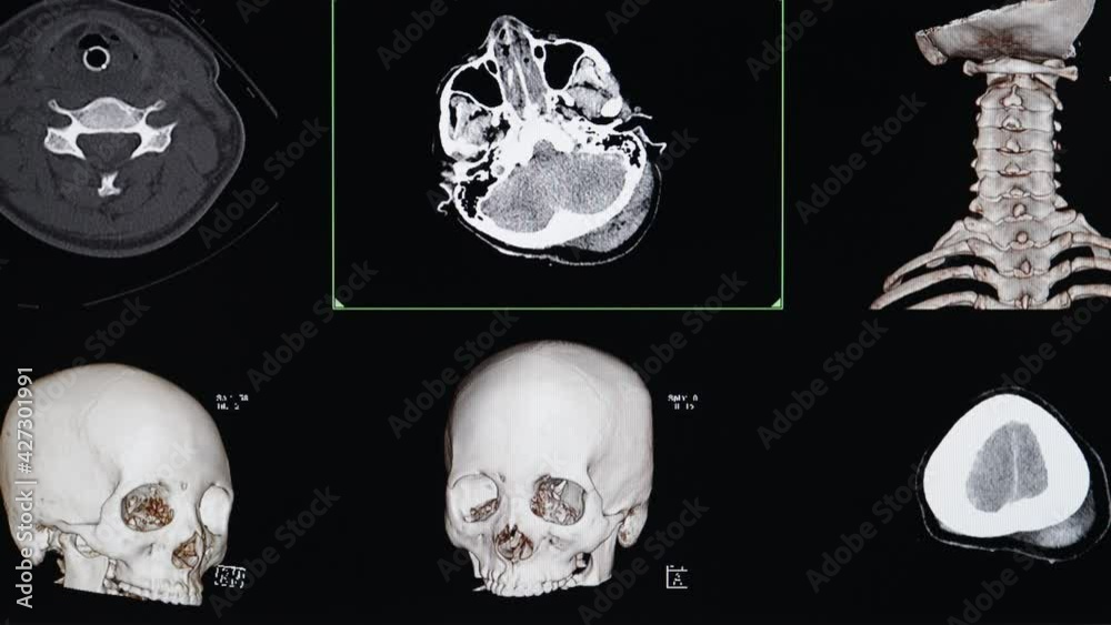 Stockvideo Multi screens CT cine scan of a patient withtraumatic brain ...