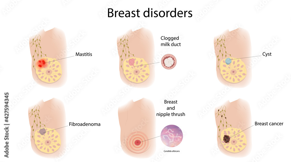 Woman breast disorders. Mastitis, cyst, thrush, cancer, Fibroadenoma, Clogged milk duct. Medical ...