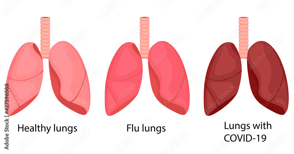 Flu lungs, covid-19, healthy. change in the color of the lungs with ...