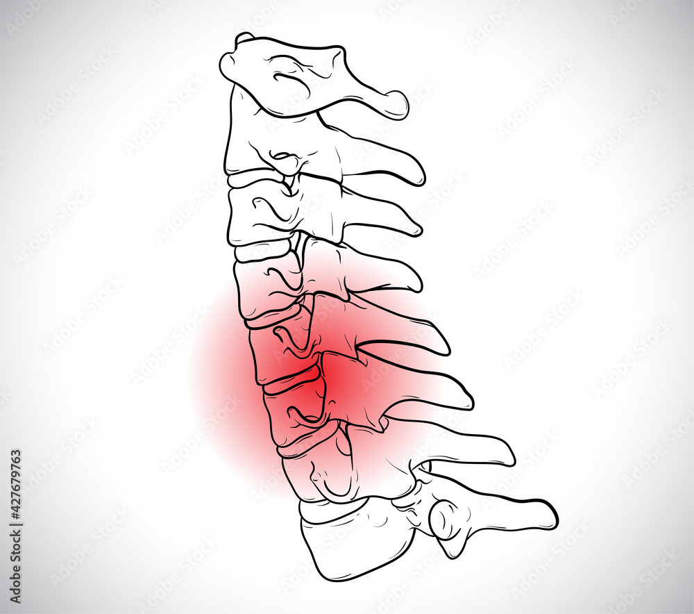 Medically correct vertebrae of the cervical spine showing problematic ...