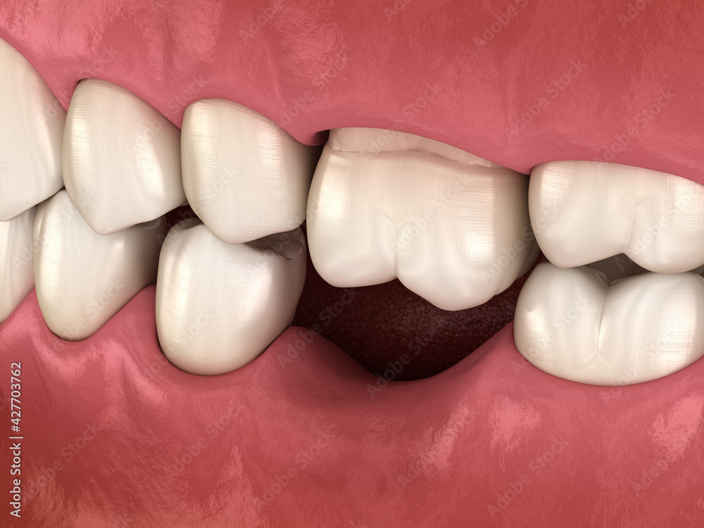 Teeth shift deformatiuon after losing molar tooth. 3D illustration of ...