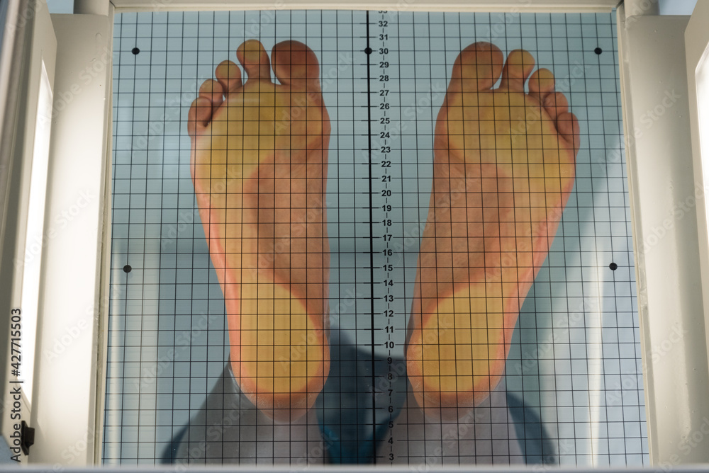 The patient stands on a special apparatus for determining flat feet ...