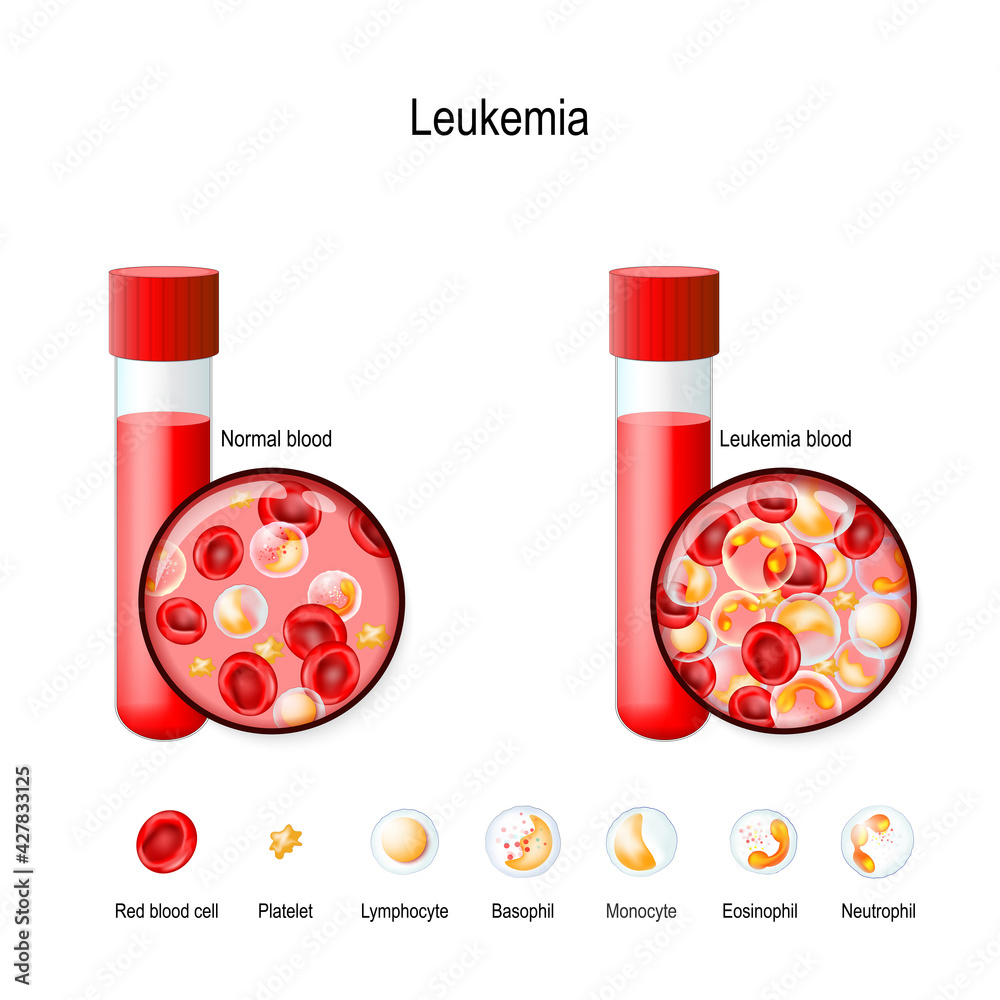 Leukemia. Red and white blood cell in Test tube. comparison and ...