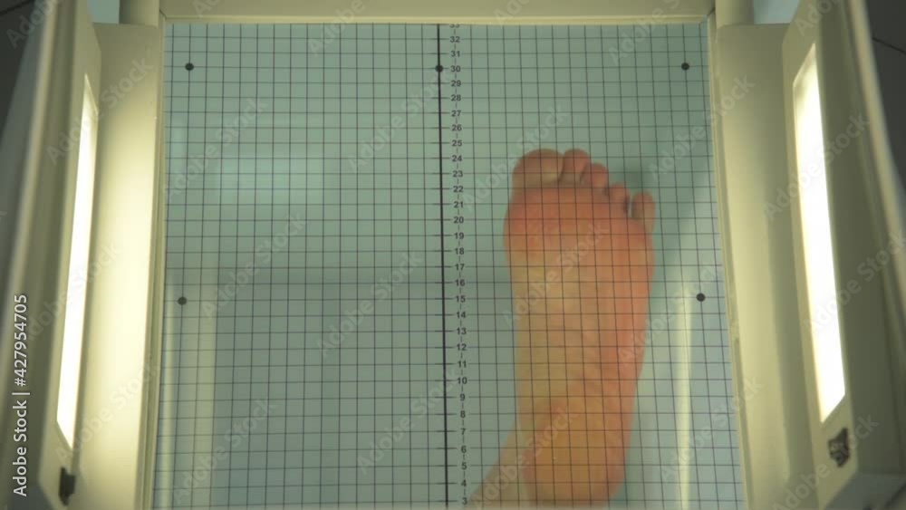 The patient stands on a special apparatus for determining flat feet ...