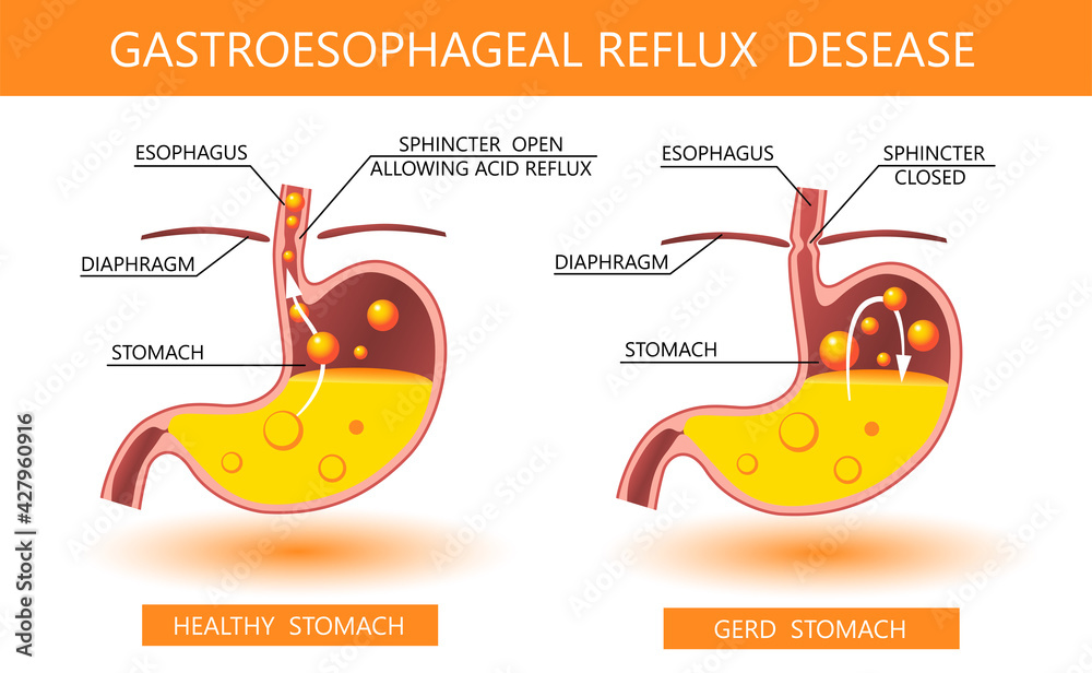 Plakat Gastroesophageal reflux disease 3d. Acid reflux, heartburn and ...