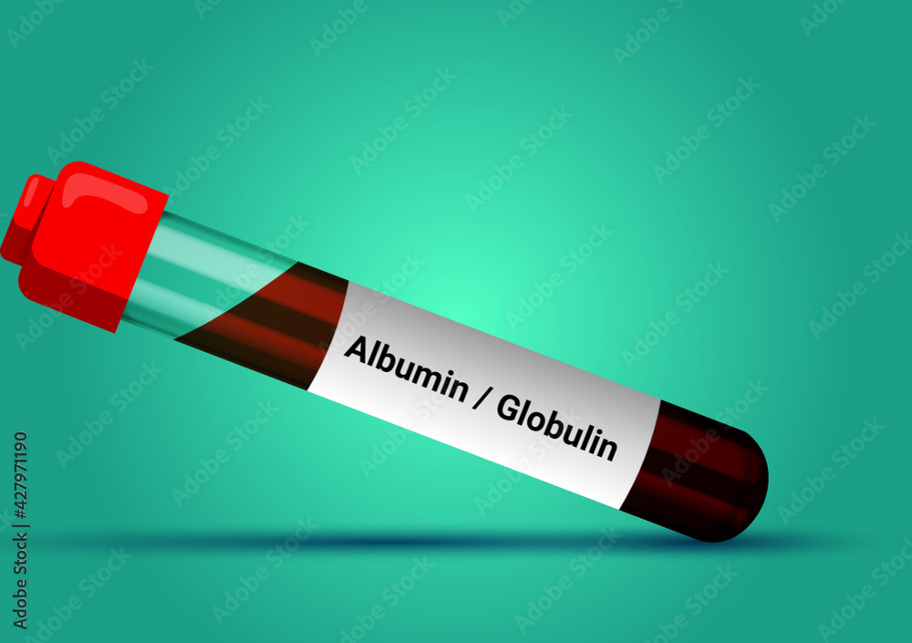 Blood sample for AG Ratio (Albumin Globulin Ratio) test, diagnosis for ...