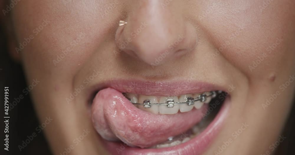 Teeth alignment by braces. Close up young woman licks lips seductively ...
