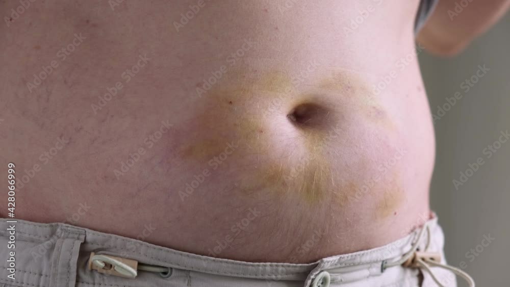 The man lifts his shirt to see and show the bruises on his stomach ...