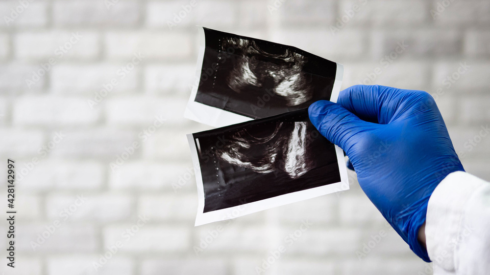 The doctor examines the ultrasound images of the prostate gland close ...
