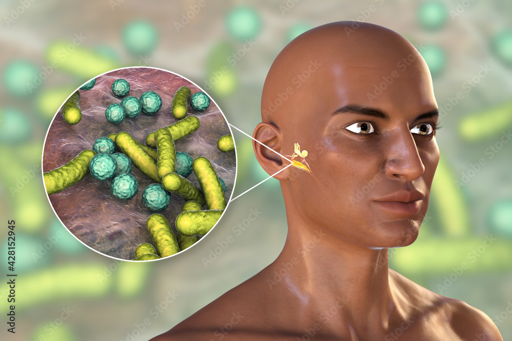 Otitis media, inflammatory disease of the middle ear, and closeup view ...