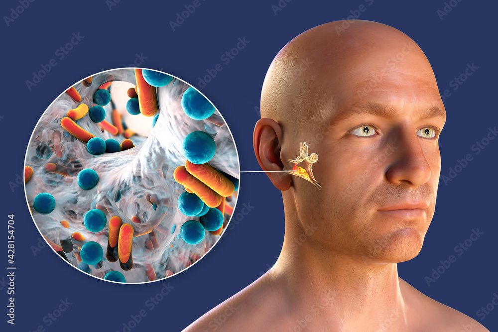 Otitis media, inflammatory disease of the middle ear, and closeup view ...