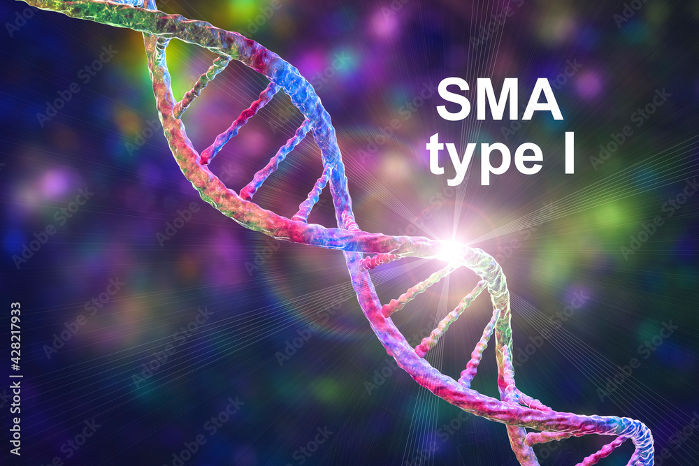Spinal muscular atrophy, SMA, a genetic neuromuscular disorder Stock ...