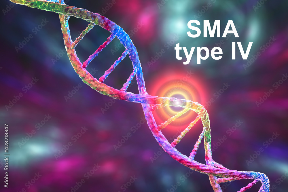 Spinal muscular atrophy, SMA, a genetic neuromuscular disorder Stock ...