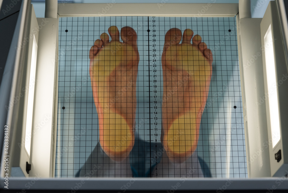 Fotka „The patient stands on a special apparatus for determining flat ...