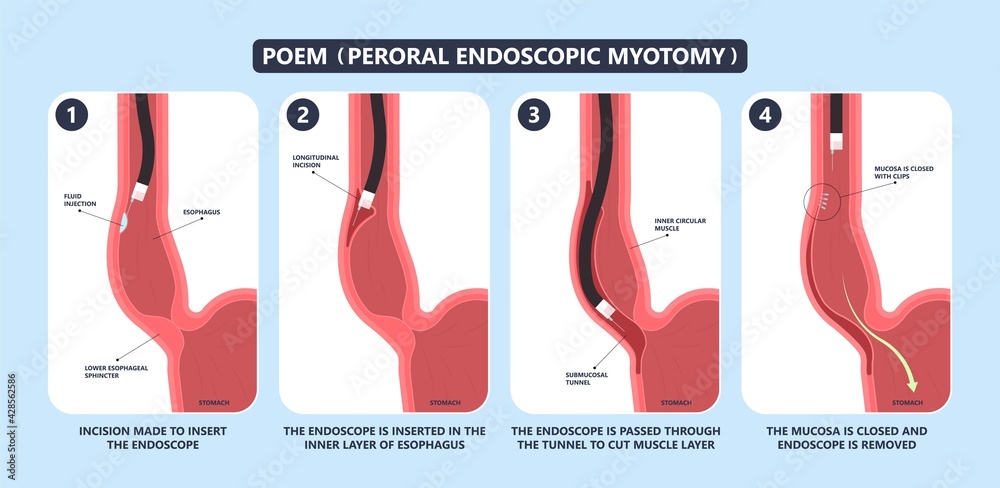 POEM Per oral surgery treat surgical GERD tract lower food damage ...
