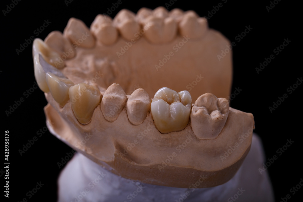 Mold of teeth. Gypsum model plaster of teeth. Plaster cast of teeth ...