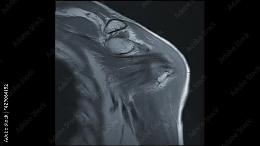 MRI Shoulder joint or Magnetic resonance imaging of Shoulder Joint ...