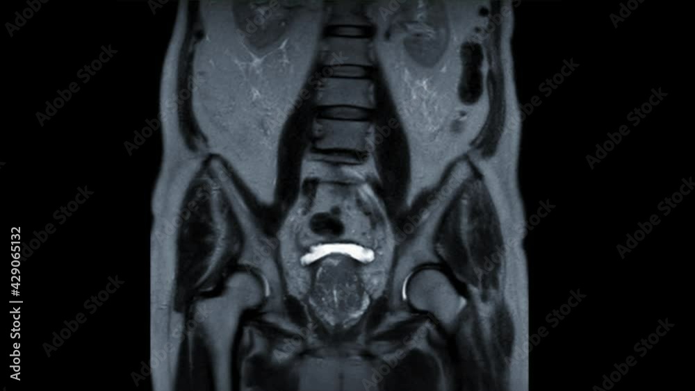 MRI prostate gland Coronal T2W view for diagnosis prostate cancer cell ...