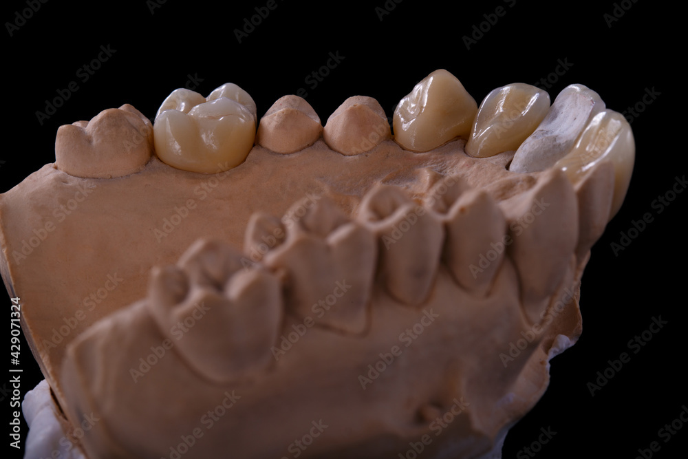 Mold of teeth. Gypsum model plaster of teeth. Plaster cast of teeth ...