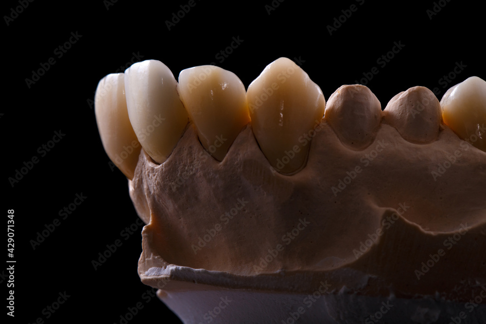 Mold of teeth. Gypsum model plaster of teeth. Stomatologic plaster cast ...