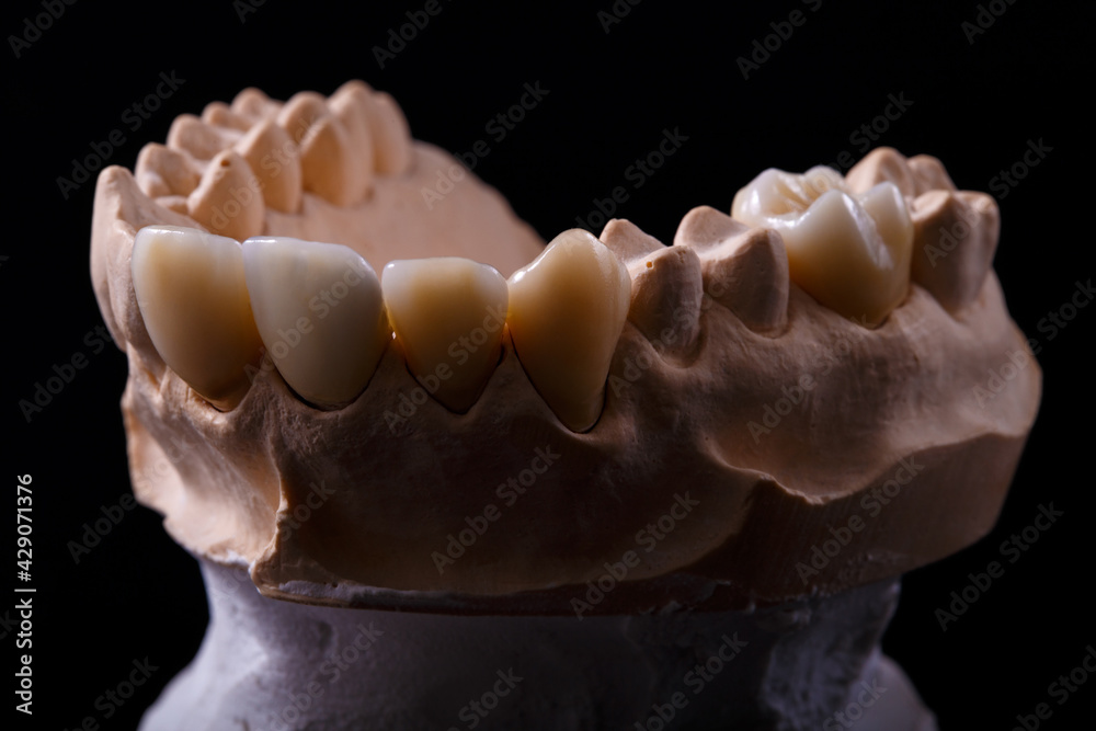 Mold of teeth. Gypsum model plaster of teeth. Plaster cast of teeth ...