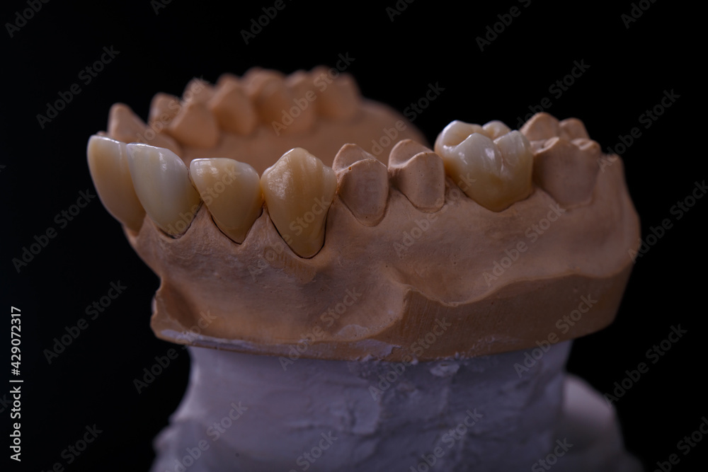 Mold of teeth. Gypsum model plaster of teeth. Stomatologic plaster cast ...