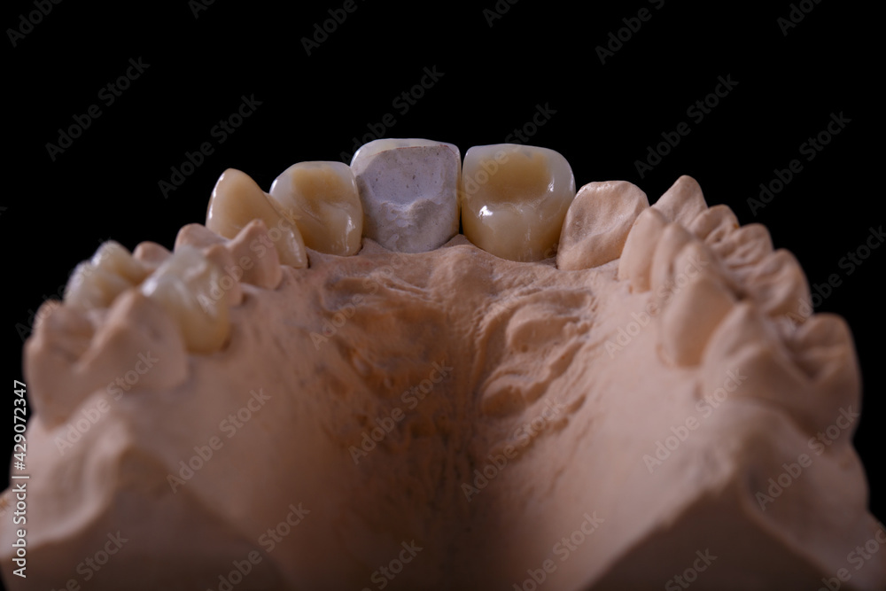 Mold of teeth. Gypsum model plaster of teeth. Plaster cast of teeth ...